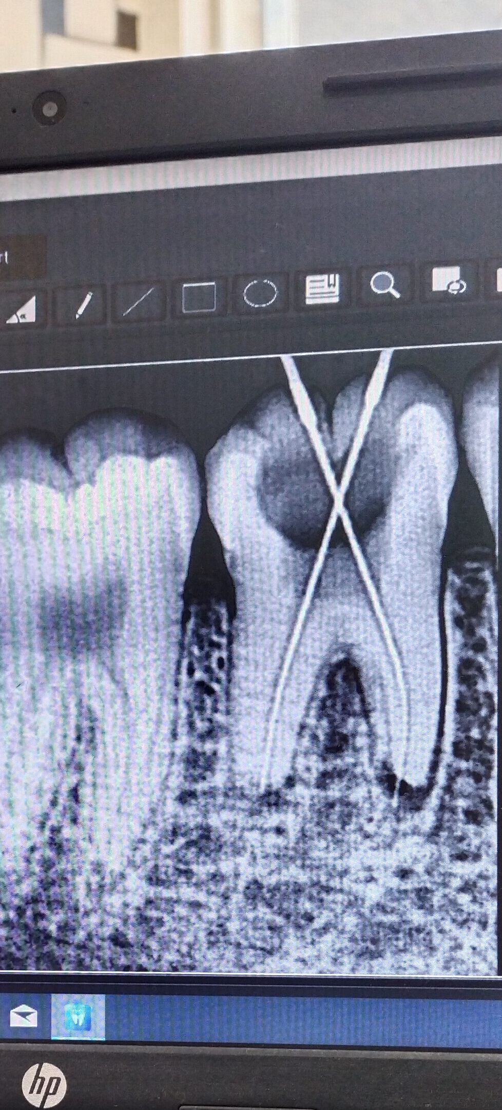 "Preserving Dental Health: A Successful Root Canal Treatment Case in a ...