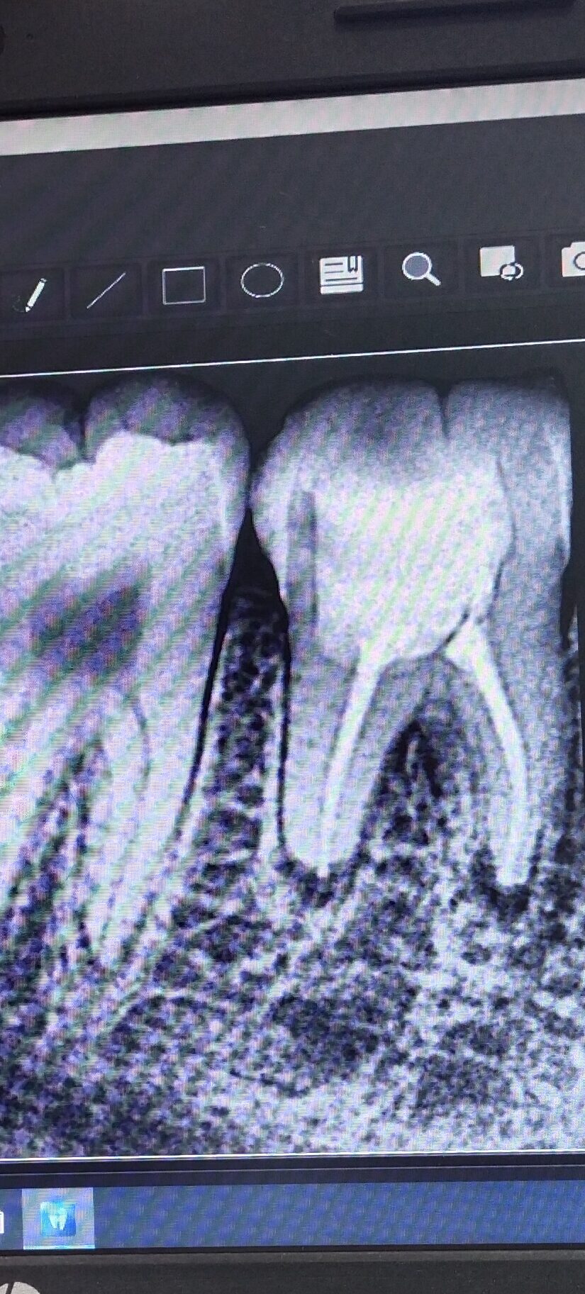 "Preserving Dental Health: A Successful Root Canal Treatment Case in a ...